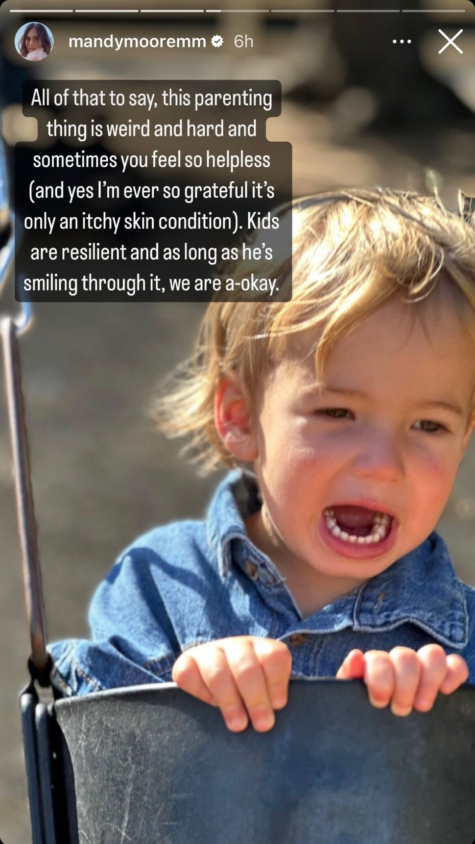 Mandy Moore Reveals Son Gus Has Gianotti-Crosti Syndrome as She Posts Pics of His 'Crazy Rash ...