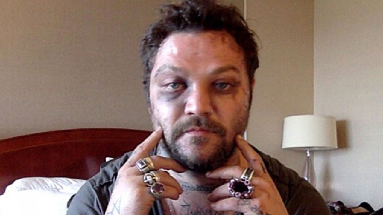 Bam Margera Shares Brutal Injury Photos After Attack by Icelandic Rappers