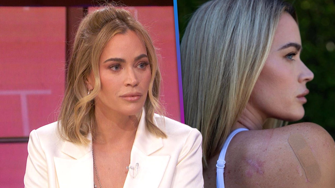 Teddi Mellencamp Reflects on Skin Cancer Journey (Exclusive)