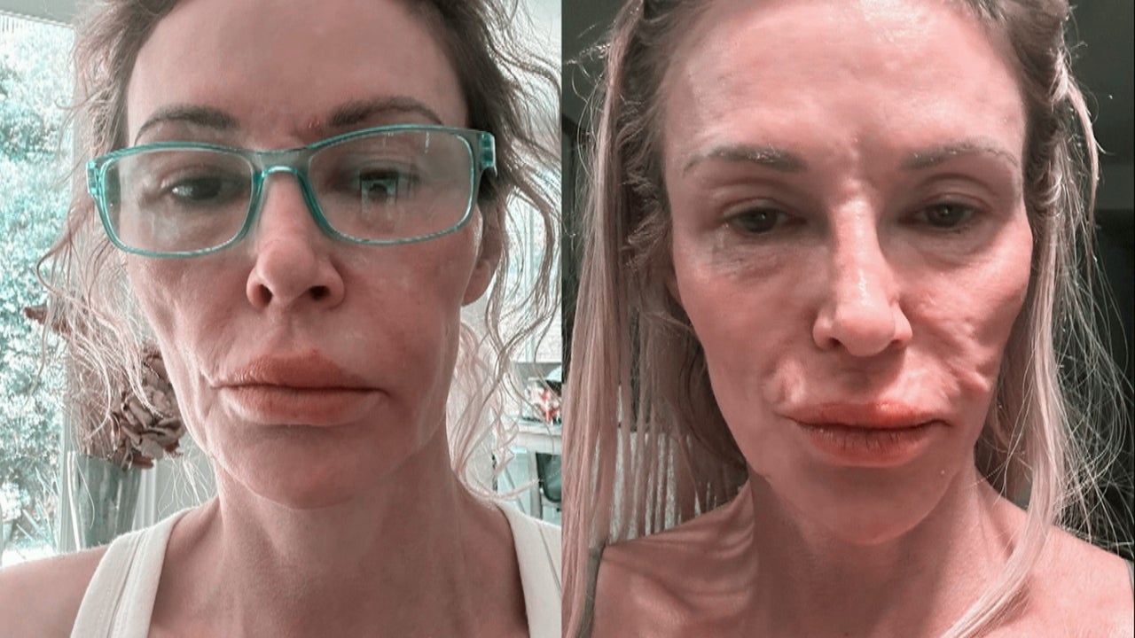‘RHOBH’s Brandi Glanville Reveals She’s Spent $70K on Face Parasite ...